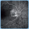Retinal Tumors in Adults: Diagnosis and Management