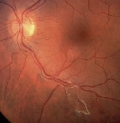 Retinal Tumors in Adults: Diagnosis and Management