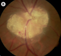 Retinal Tumors in Adults: Diagnosis and Management
