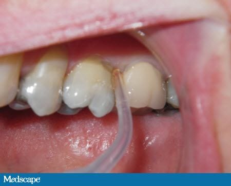 Treating Periodontitis With Local Antibiotics - Page 2