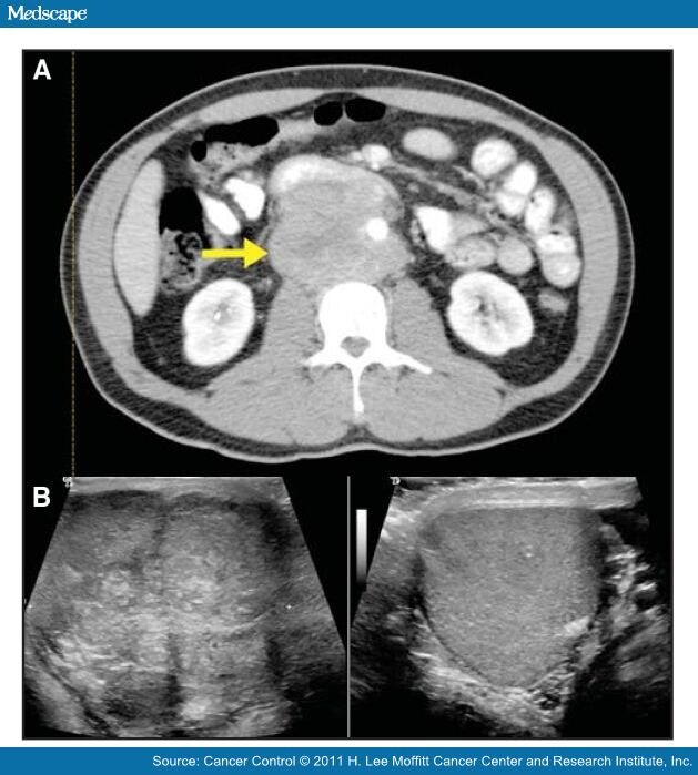 Current Diagnosis and Management of Retroperitoneal Sarcoma