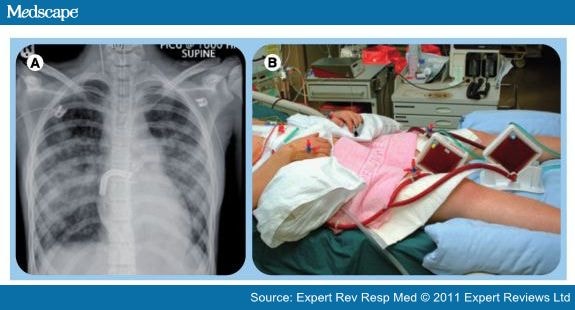Pulmonary Arterial Hypertension and Lung Transplantation - Page 12