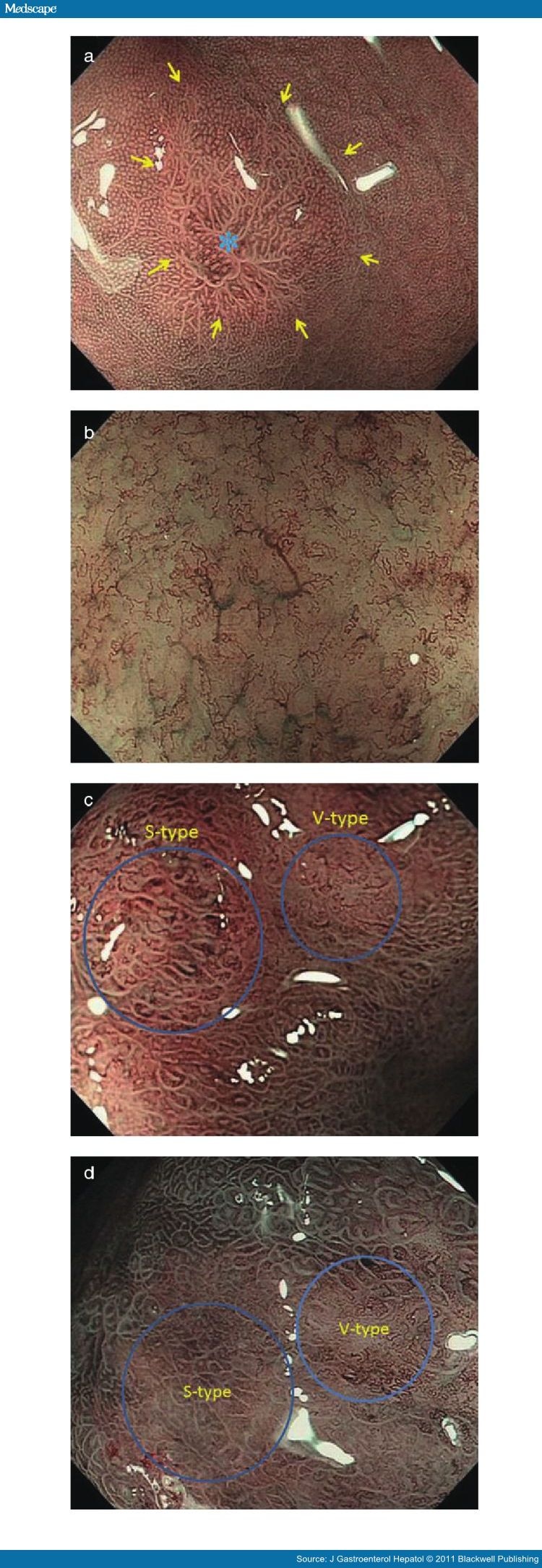 Endoscopy For Early Gastric Cancer at Julie Knight blog