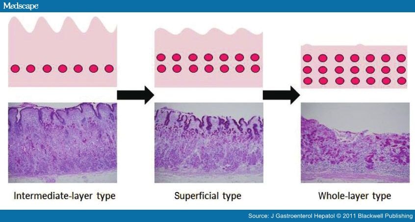 Gastric Cancer Diagnosis: Endoscopy With Narrow-band Imaging - Page 2