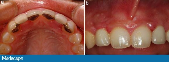 A Young Woman With Missing Lateral Incisors - Page 3