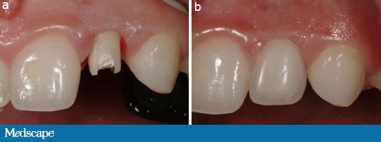 A Young Woman With Missing Lateral Incisors - Page 3