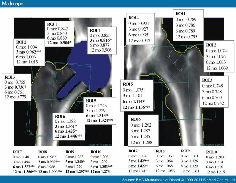 BMD of the Proximal Femur After Hip Resurfacing Arthroplasty - Page 3