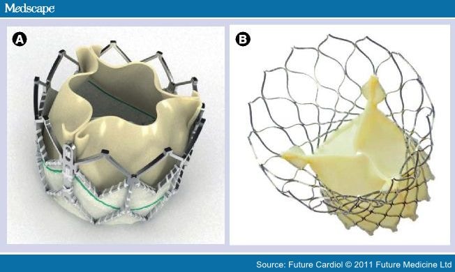 TAVI: Patient Selection and Procedural Considerations