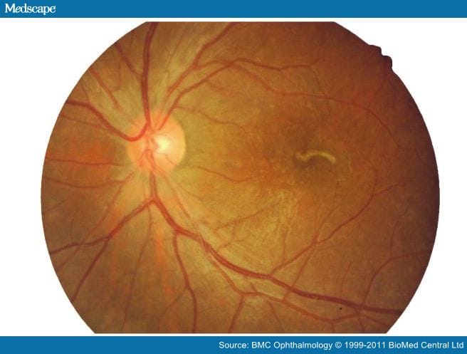 Intraocular Nematode With Unilateral Subacute Neuroretinitis - Page 3