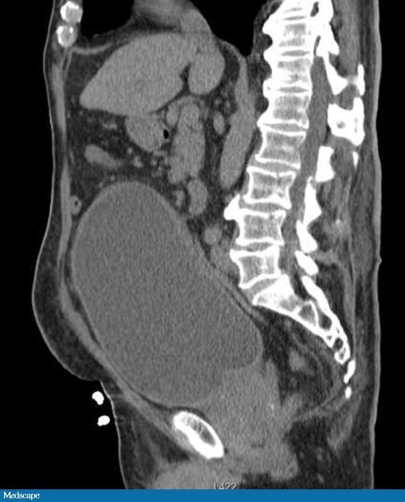 Insidious Abdominal Symptoms With Urinary Disturbances