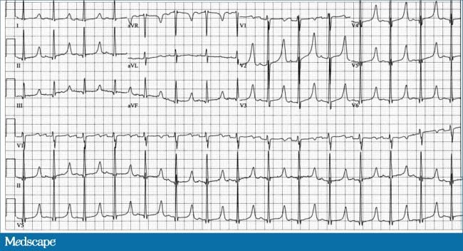 Check the T Waves and Make a Diagnosis