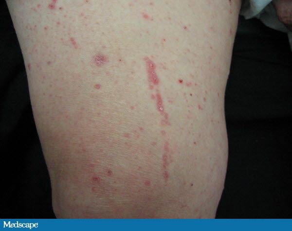 A 48-Year-Old Woman With an Itchy Rash
