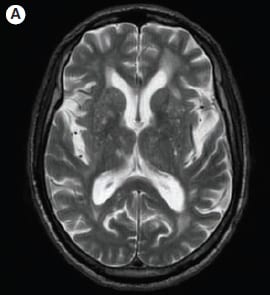 Cerebral Microbleeds: Detection, Mechanisms, and Clinical Challenges