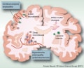 Cerebral Microbleeds: Detection, Mechanisms, and Clinical Challenges