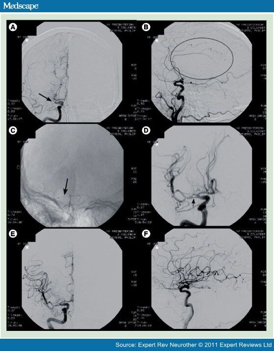 Revascularization for Acute Ischemic Stroke Treatment - Page 10