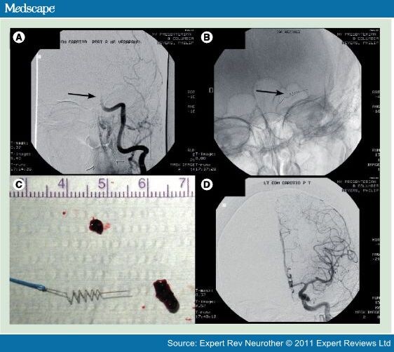 Revascularization for Acute Ischemic Stroke Treatment - Page 12