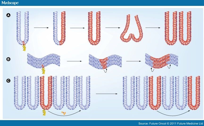 Field Cancerization in the GI Tract - Page 9
