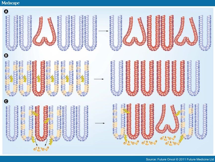 Field Cancerization in the GI Tract - Page 11