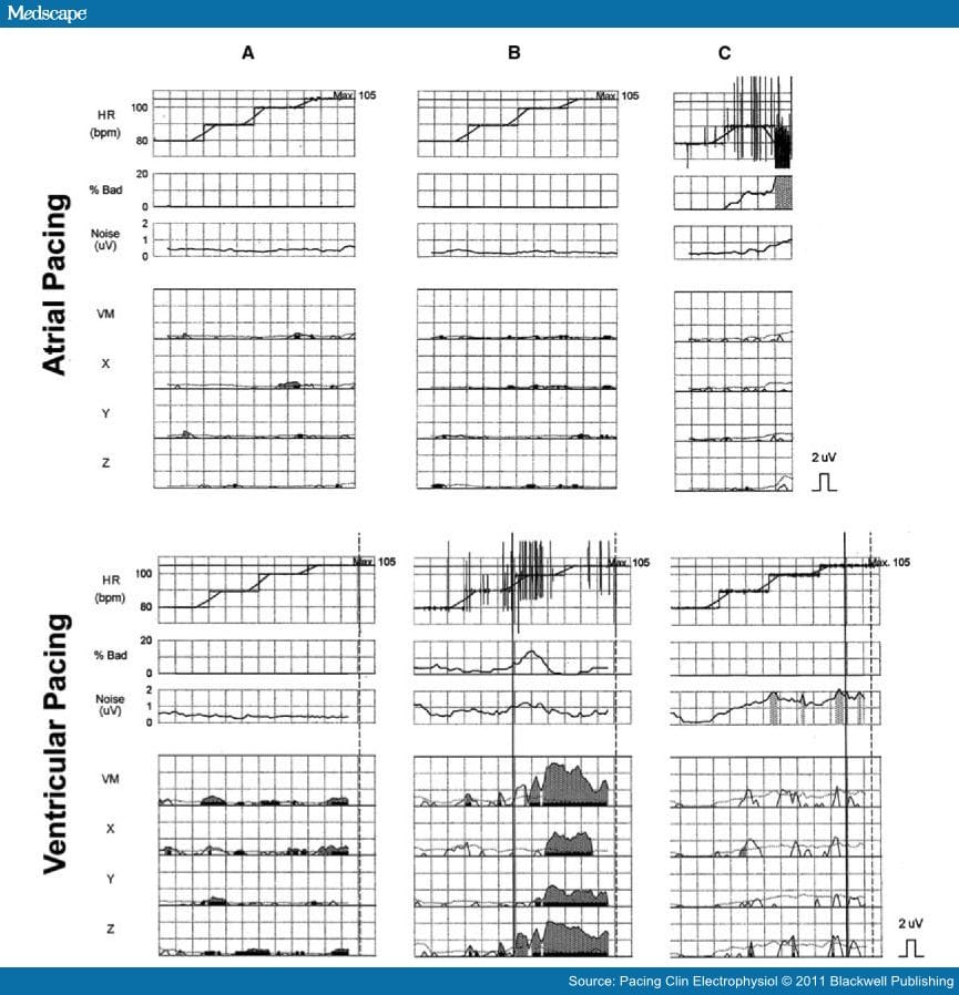 T-Wave Alternans Testing in Pacemaker Patients - Page 3