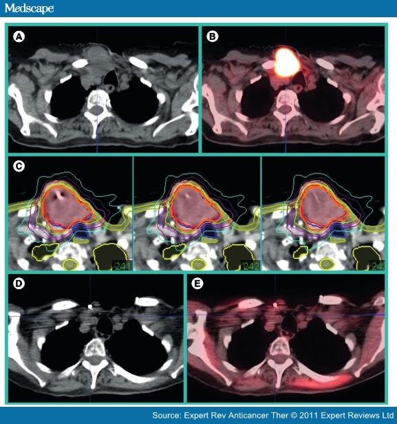 Stereotactic Body Radiation Therapy for Head And Neck Cancer - Page 4