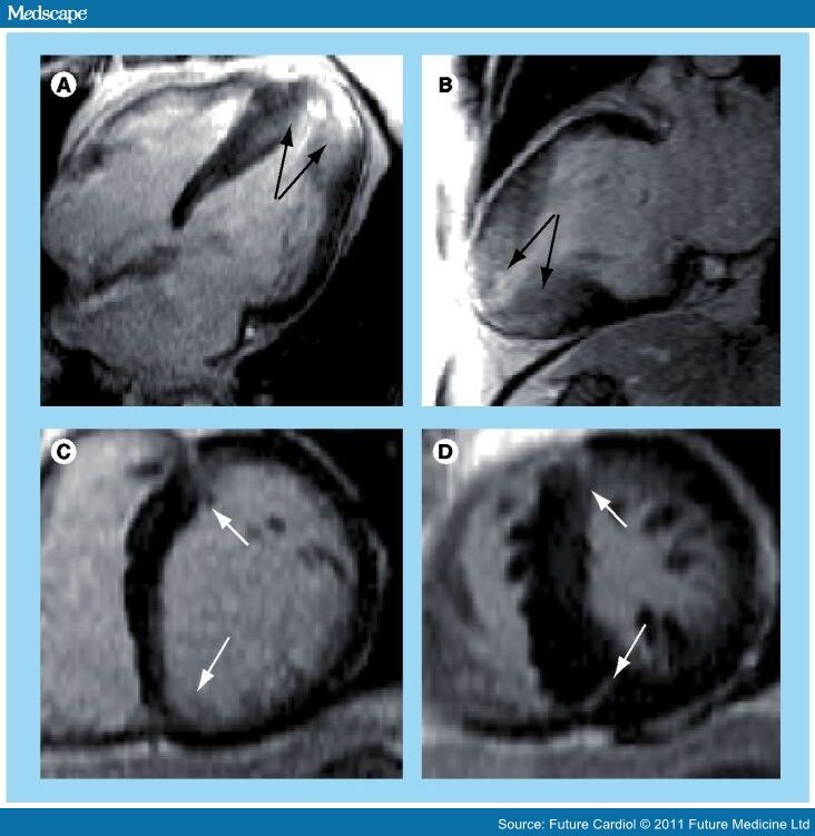 Novel Imaging Techniques for Diffuse Myocardial Fibrosis - Page 3
