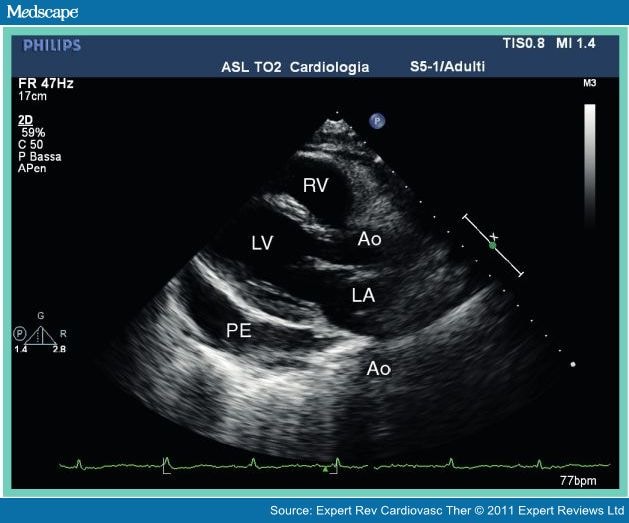 Evaluation and Management of Pericarditis - Page 4