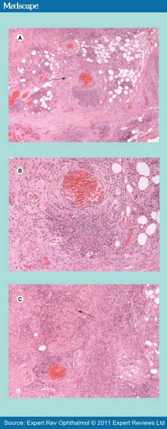 Ocular Manifestations of Wegener's Granulomatosis