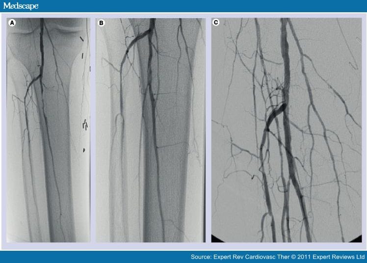 DES for Infrapopliteal Disease in Critical Limb Ischemia - Page 5
