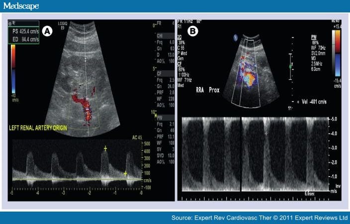 Atherosclerotic Renal Artery Stenosis and Renal Artery Stenting - Page 4