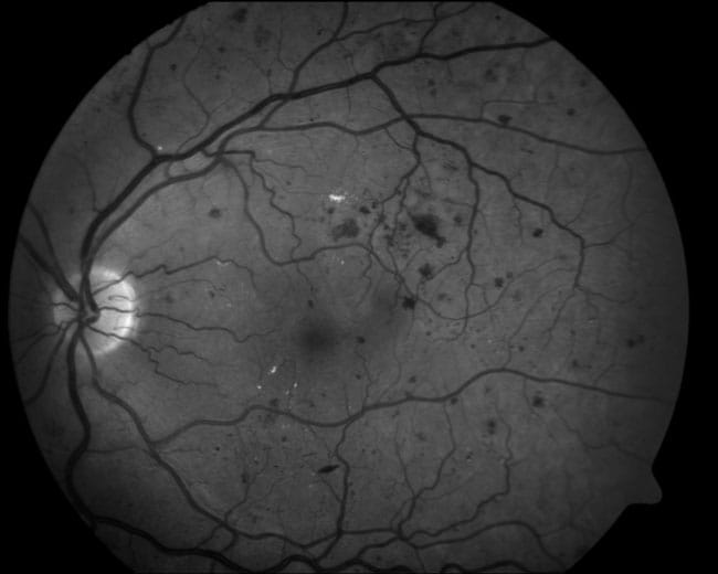 Diabetic Macular Edema: Diagnosis and Management