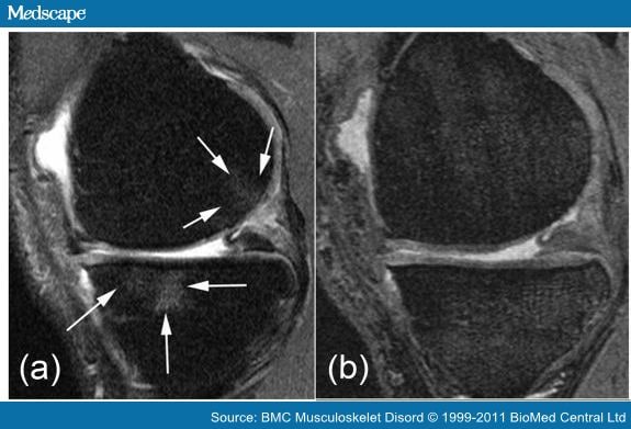Assessing Subchondral Lesions and Knee Cysts With MRI - Page 4