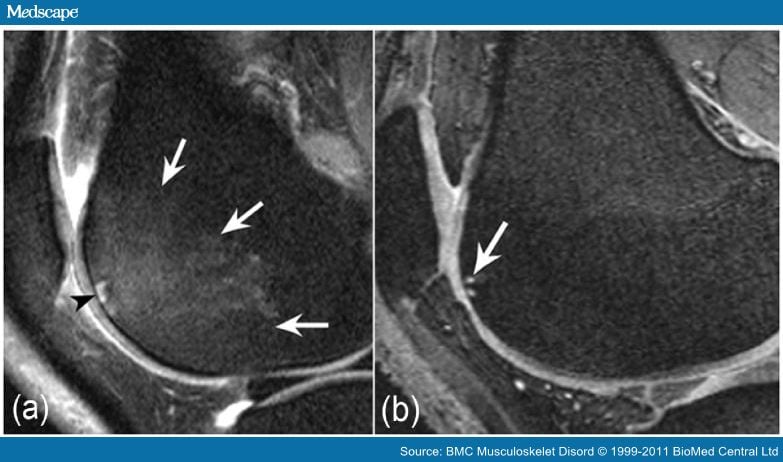 Assessing Subchondral Lesions and Knee Cysts With MRI - Page 4