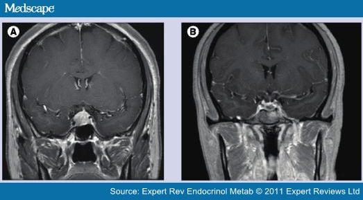 The Diagnosis and Management of Lymphocytic Hypophysitis