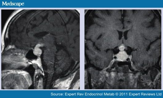 The Diagnosis And Management Of Lymphocytic Hypophysitis