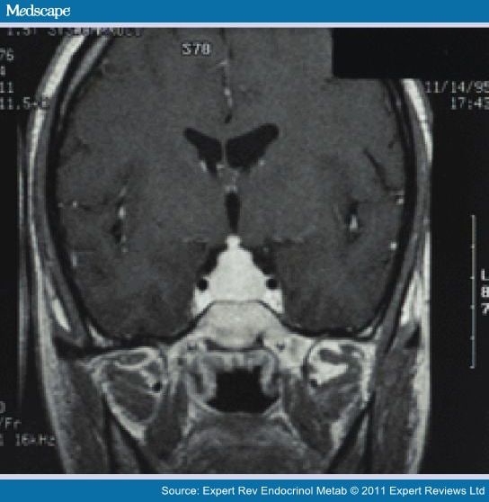 The Diagnosis and Management of Lymphocytic Hypophysitis