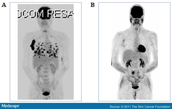 How Zelboraf Extends Life for Patients With Metastatic Melanoma - Page 3
