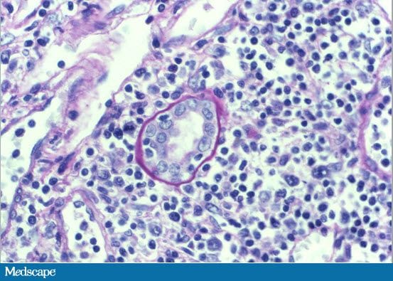 Posttransplant Viral Infections: Understanding and Managing the Risk
