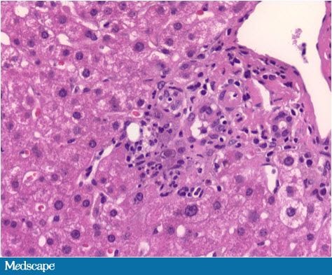 Posttransplant Viral Infections: Understanding and Managing the Risk