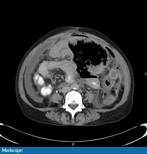 Constipation, Abdominal Pain, and a Strong Family History - Page 2