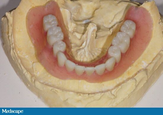 One-Hour Complete Dentures - Page 3
