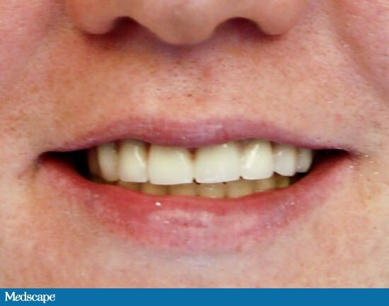 One-Hour Complete Dentures - Page 3