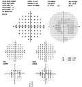 Humphrey Visual Field Findings in Hydroxychloroquine Toxicity