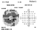 Humphrey Visual Field Findings in Hydroxychloroquine Toxicity