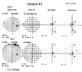 Humphrey Visual Field Findings in Hydroxychloroquine Toxicity