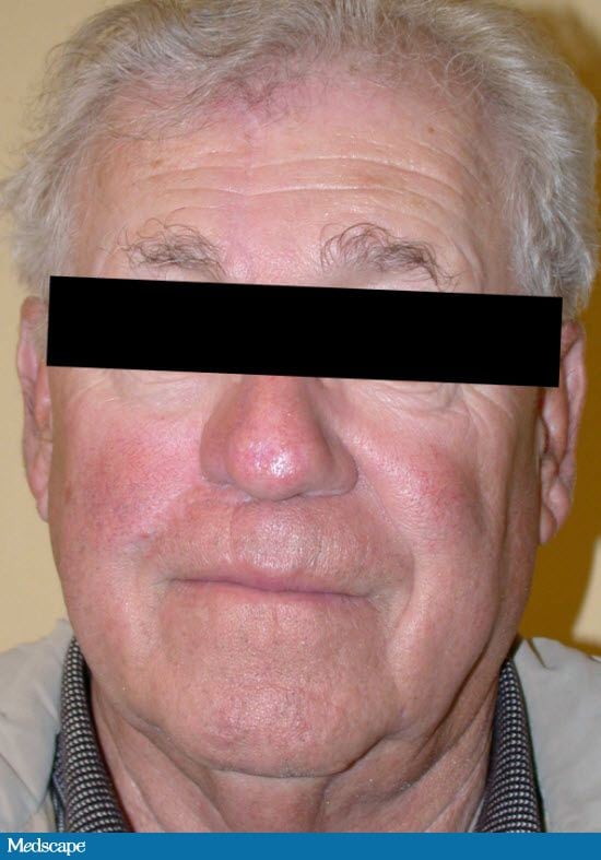 Facial and Nasal Cancer Reconstruction Case Study - Page 3