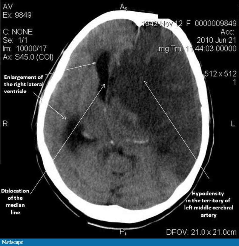 Severe Weakness And Speech Disturbance severe-weakness-and-speech-disturbance