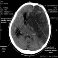 Sudden-Onset Aphasia and Right Hemiparesis in a 67-Year-Old Woman