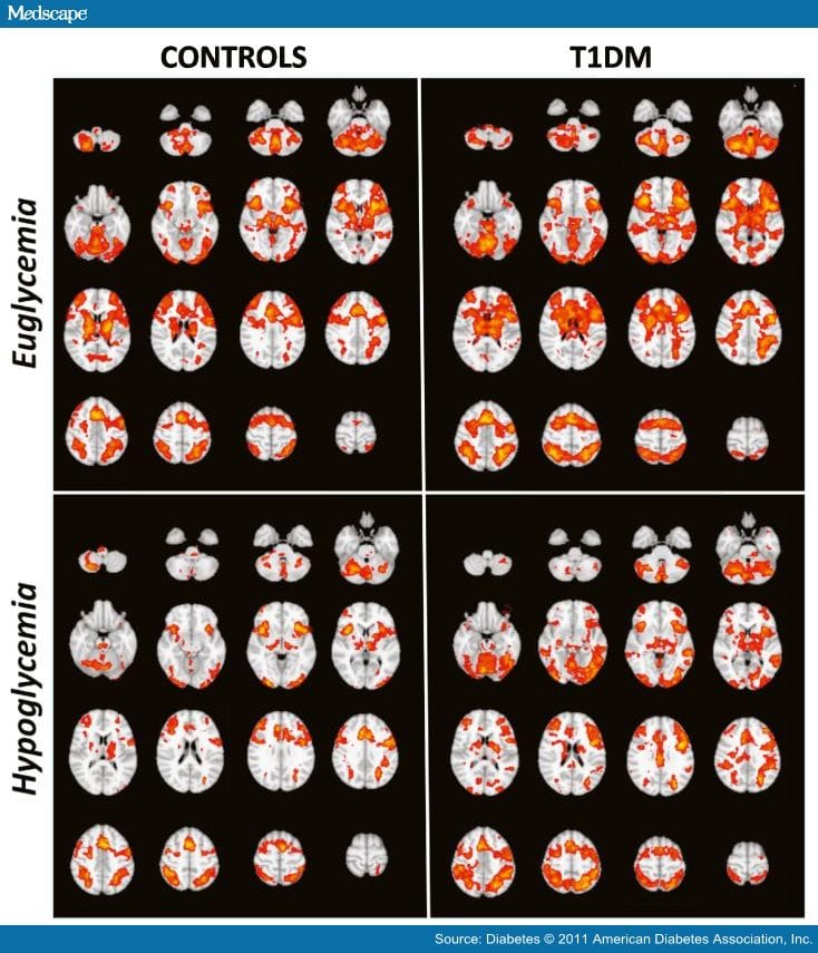 Brain Activation and Memory During Hypoglycemia in Type 1 DM - Page 3