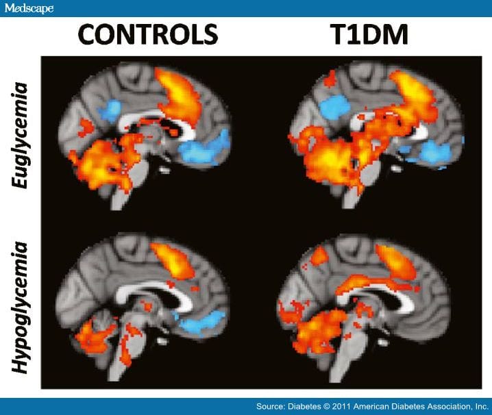 Brain Activation and Memory During Hypoglycemia in Type 1 DM - Page 3