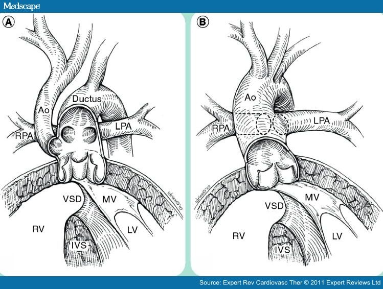 Common Arterial Trunk - Page 4